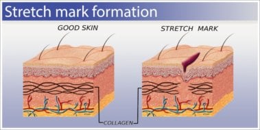Stretch Marks on Biceps & Shoulders: Causes & Fixes | Legion
