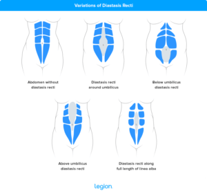 Diastasis Recti Exercises: Everything You Need to Know About How to Fix ...